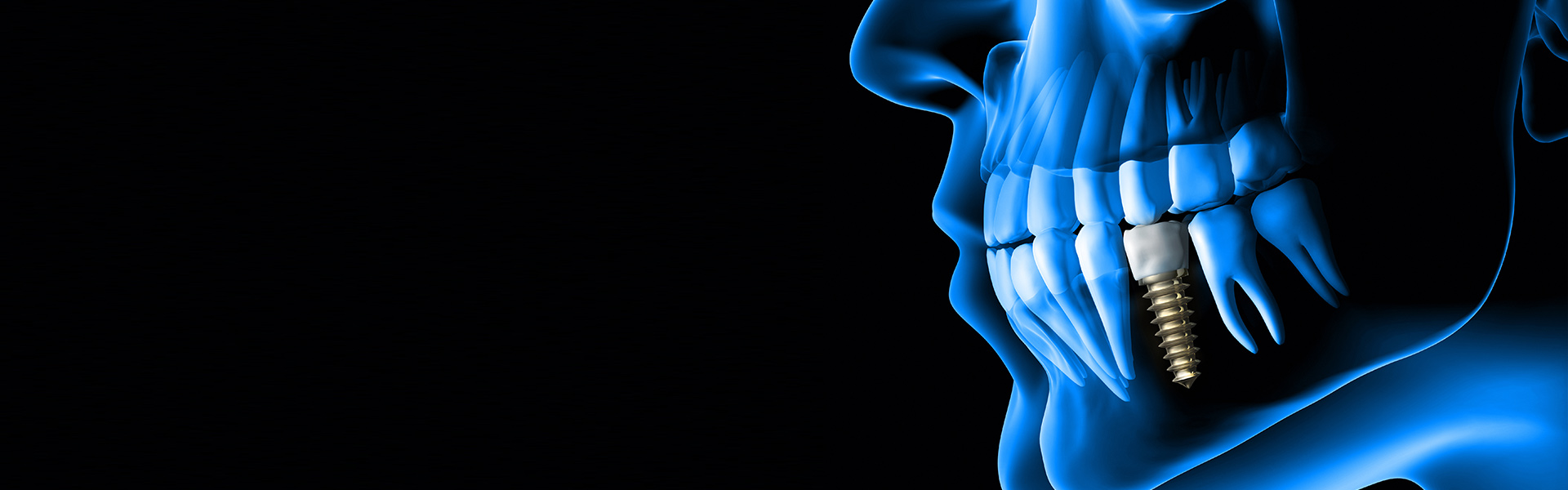 3D Dental Implant Surgery Dubai - Dr. Joy Dental Clinic