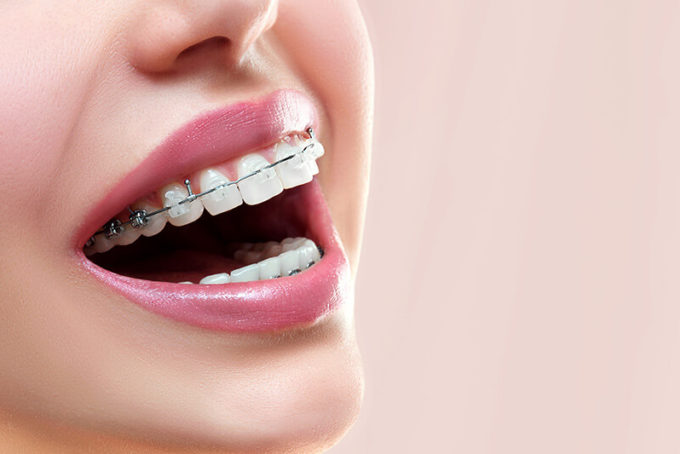 Damon Braces in Dubai - Self Ligating Braces