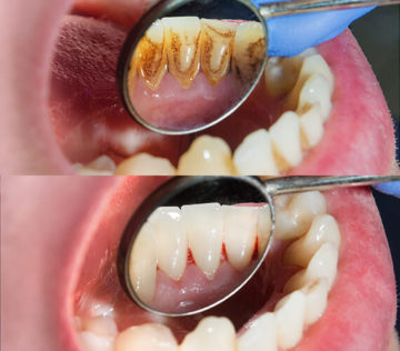 Teeth Cleaning Dubai | Dental Scaling & Polishing in Dubai - Dr Joy