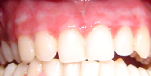 Gum Depigmentation - Gum Bleaching in Dubai - Dr. Joy Dental Clinic