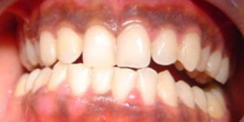Gum Depigmentation - Gum Bleaching in Dubai - Dr. Joy Dental Clinic