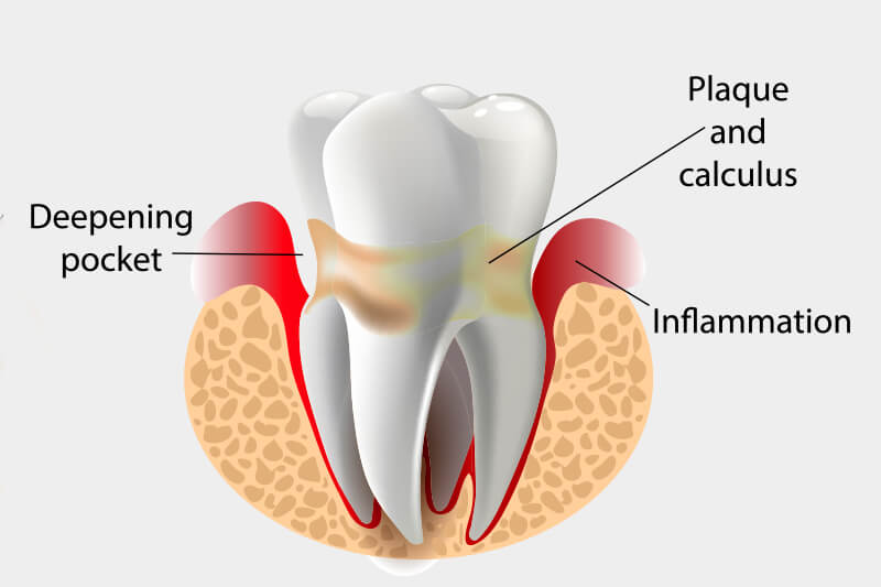 5 Reasons to have a Tooth Extraction - Dr Joy Dental Clinic