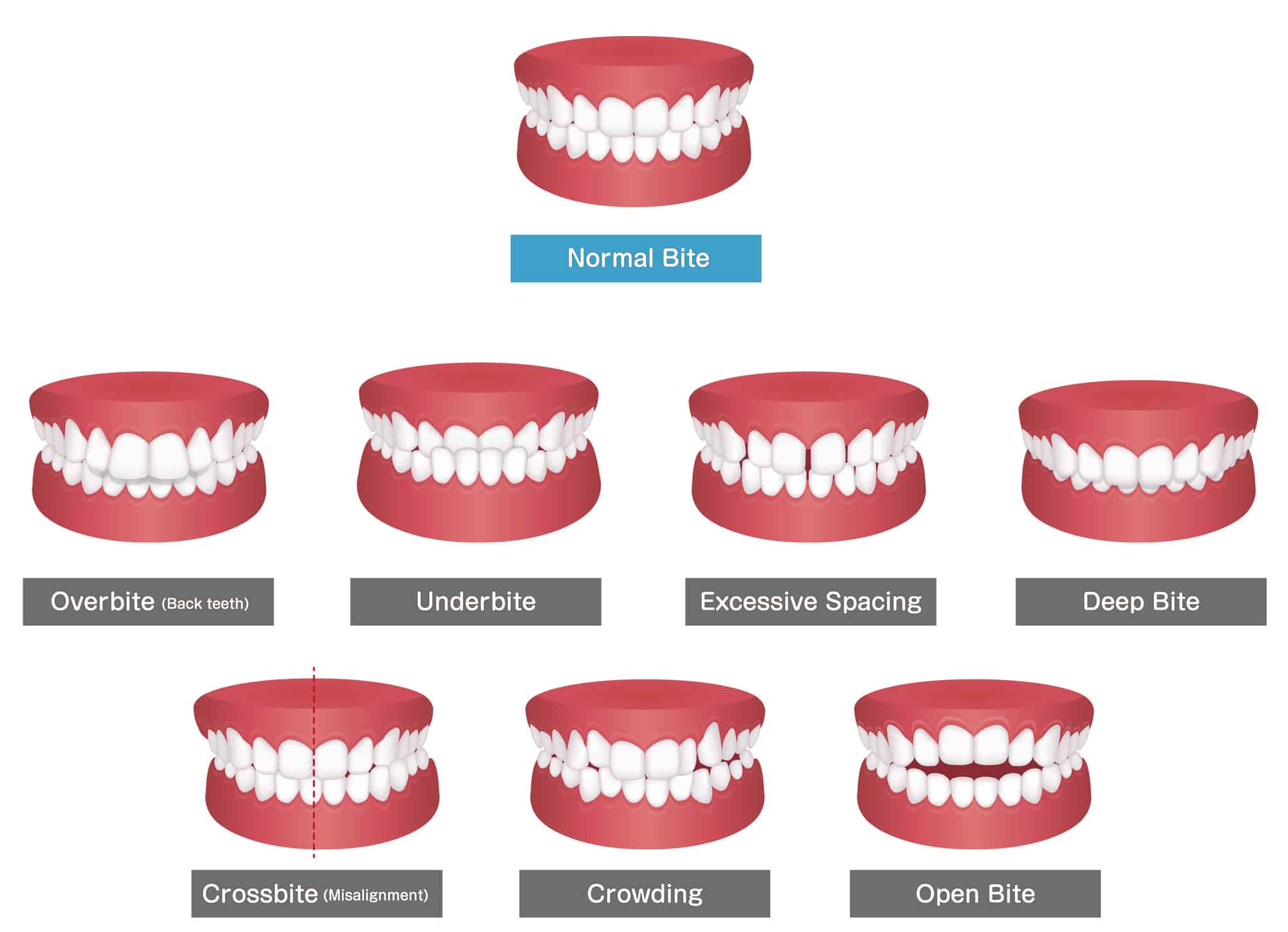 Why you should receive Invisalign Treatment only from a Specialist ...