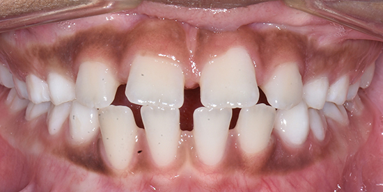 Invisalign First in Dubai - Invisible Clear Aligners for Kids- Dr Joy ...