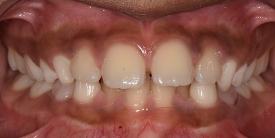 Invisalign First in Dubai - Invisible Clear Aligners for Kids- Dr Joy ...