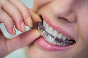 Benefits of using iTero Scanner in Invisalign Treatment - Dr Joy Dental ...