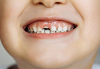 What are the causes of Delayed Dental Development? - Dr Joy Dental Clinic