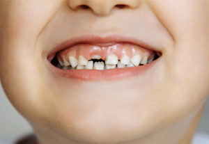 What are the causes of Delayed Dental Development? - Dr Joy Dental Clinic