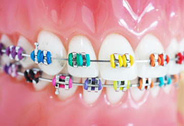 What to Consider When Choosing Colored Braces? - Dr Joy Dental Clinic