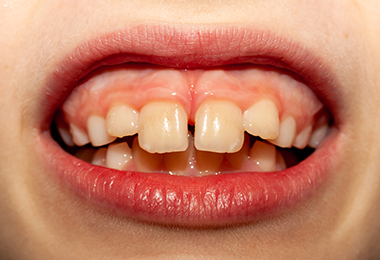 Viral Gingivitis (Gingivostomatitis) in Children: Causes and Cures - Dr ...