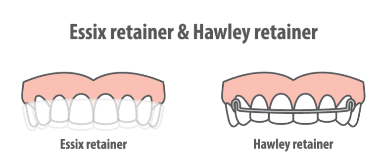 Hawley Retainer- Usage, Process and Benefits - Dr Joy Dental Clinic