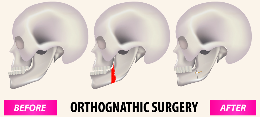 What is Orthognathic Surgery? When Is It Necessary? - Dr Joy Dental Clinic